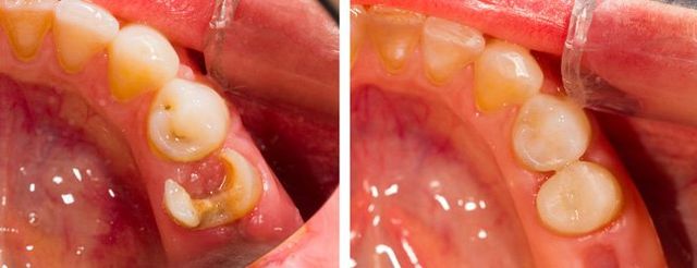 Direct & Indirect Dental Fillings Lawrenceville NJ | Dental Restoration