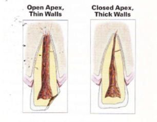 Chipped Tooth Treatment | Avulsed Tooth Treatment Dekalb, IL